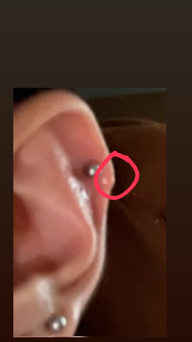 피어싱 주변 뭐가 났어요 지식in