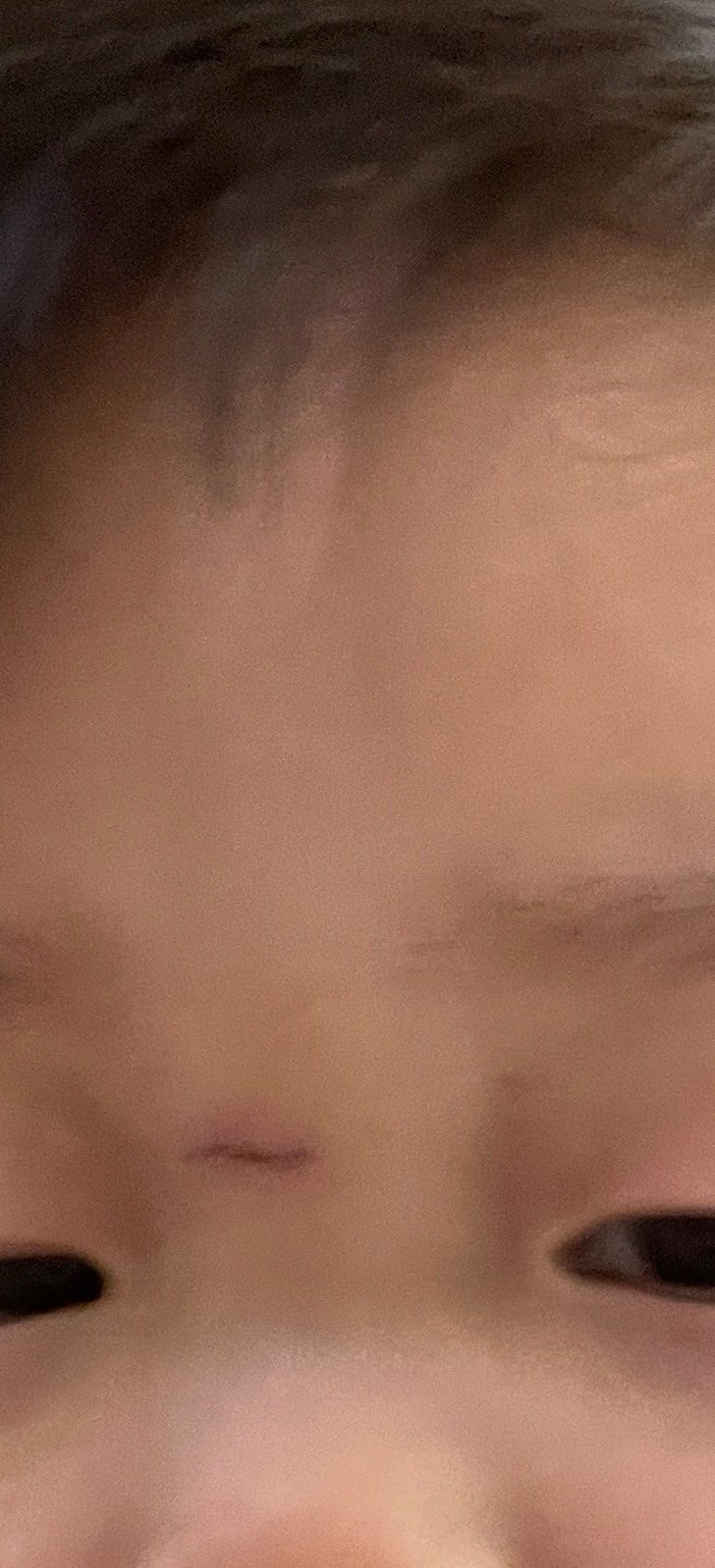 아기얼굴 봉합수술 실밥 풀기 전 어떤걸 붙여야하나요 지식in