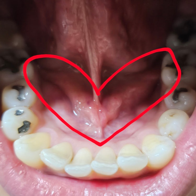 혀밑 부음? : 지식iN