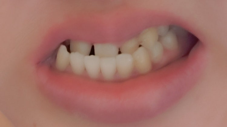 부정교합인거같은데 교정을해야하나요? : 지식iN