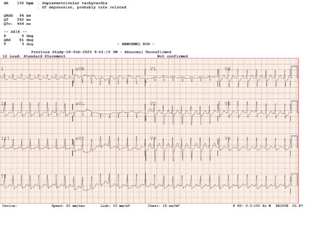psvt ekg : 지식iN