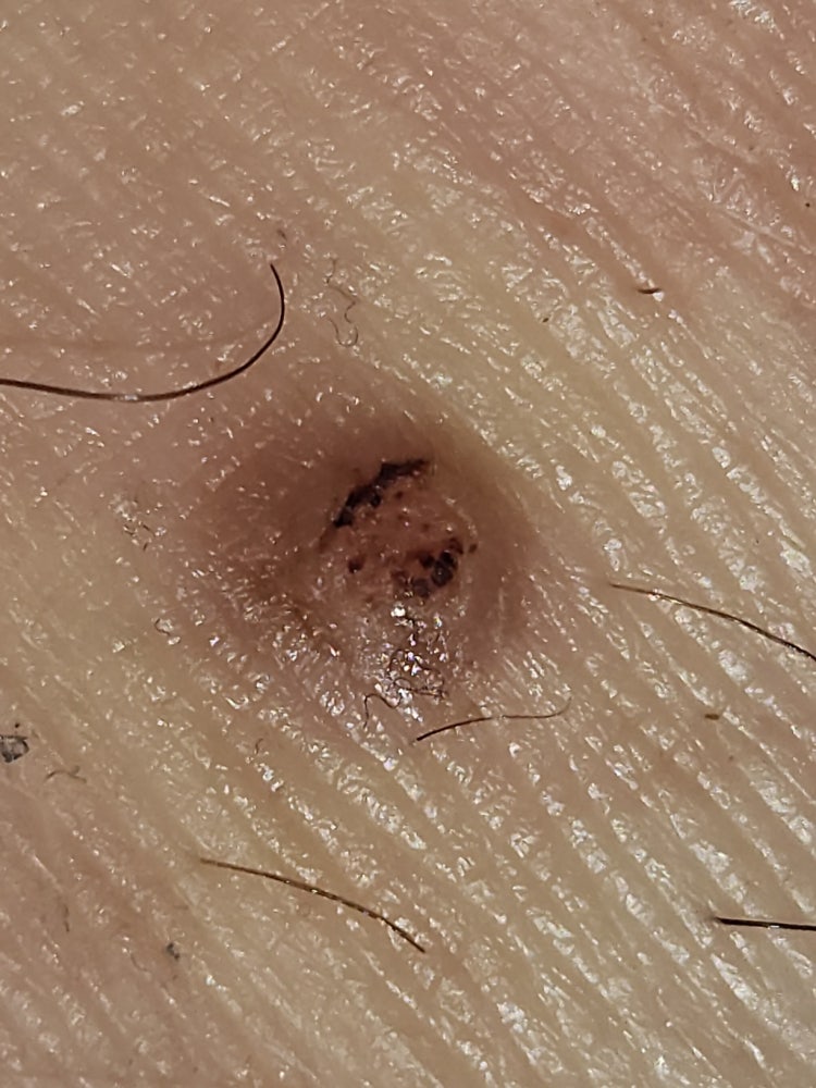 사마귀 상태 어떤가요?? : 지식iN