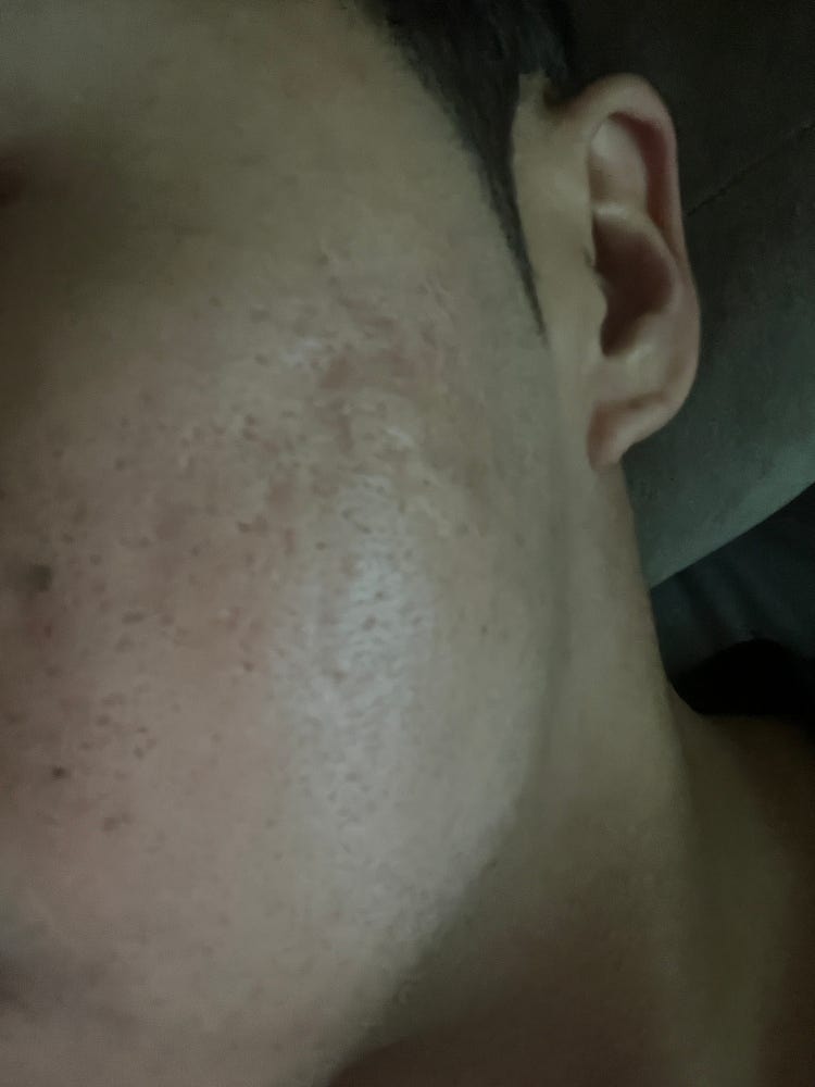 곰보피부가 고민입니다 : 지식iN